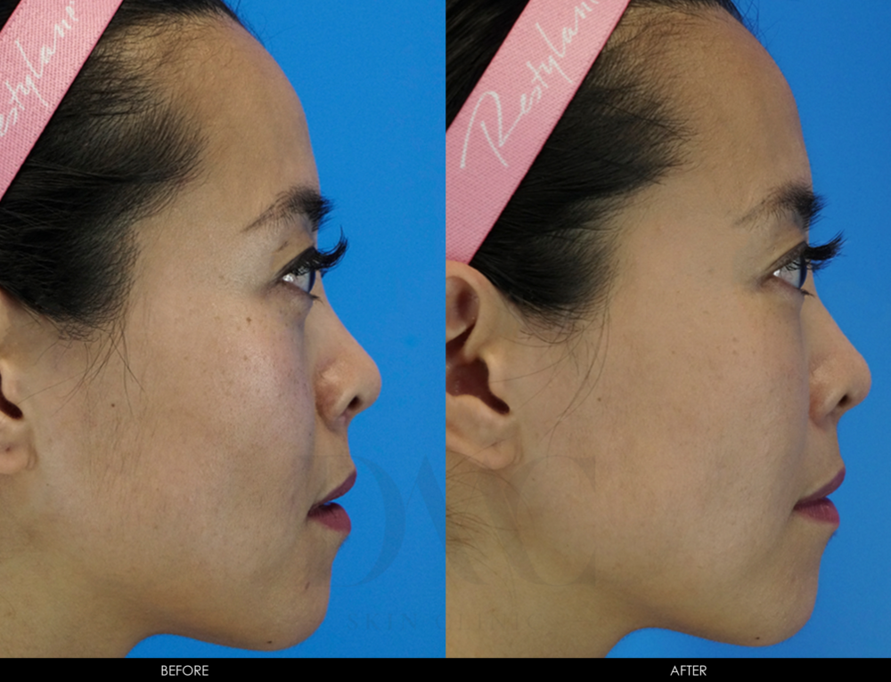 UNDER EYE & SMILE LINES 3 - DMC Skin Clinic